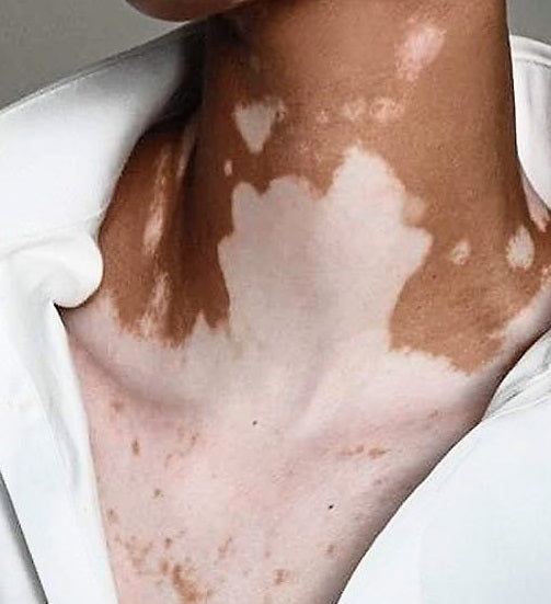 Is Vitiligo Bad for Health? – dermahealer.com
